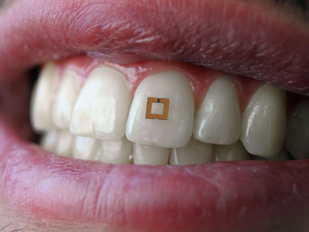 A Wearable RFID Fitness & Calorie Tracker that Mounts to Your Teeth ...